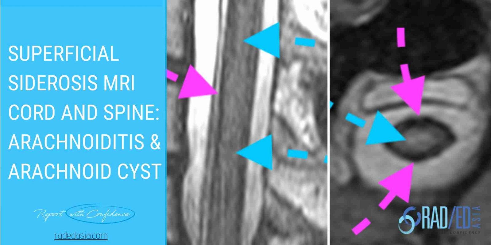 SUPERFICIAL SIDEROSIS MRI CORD AND SPINE (UPDATED 2021) - Radedasia
