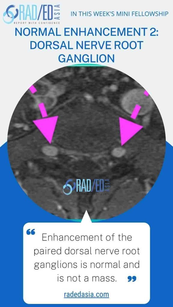 LUMBAR SPINE ENHANCEMENT MRI ONLINE RADIOLOGY COURSES: KEY POINTS FROM ...