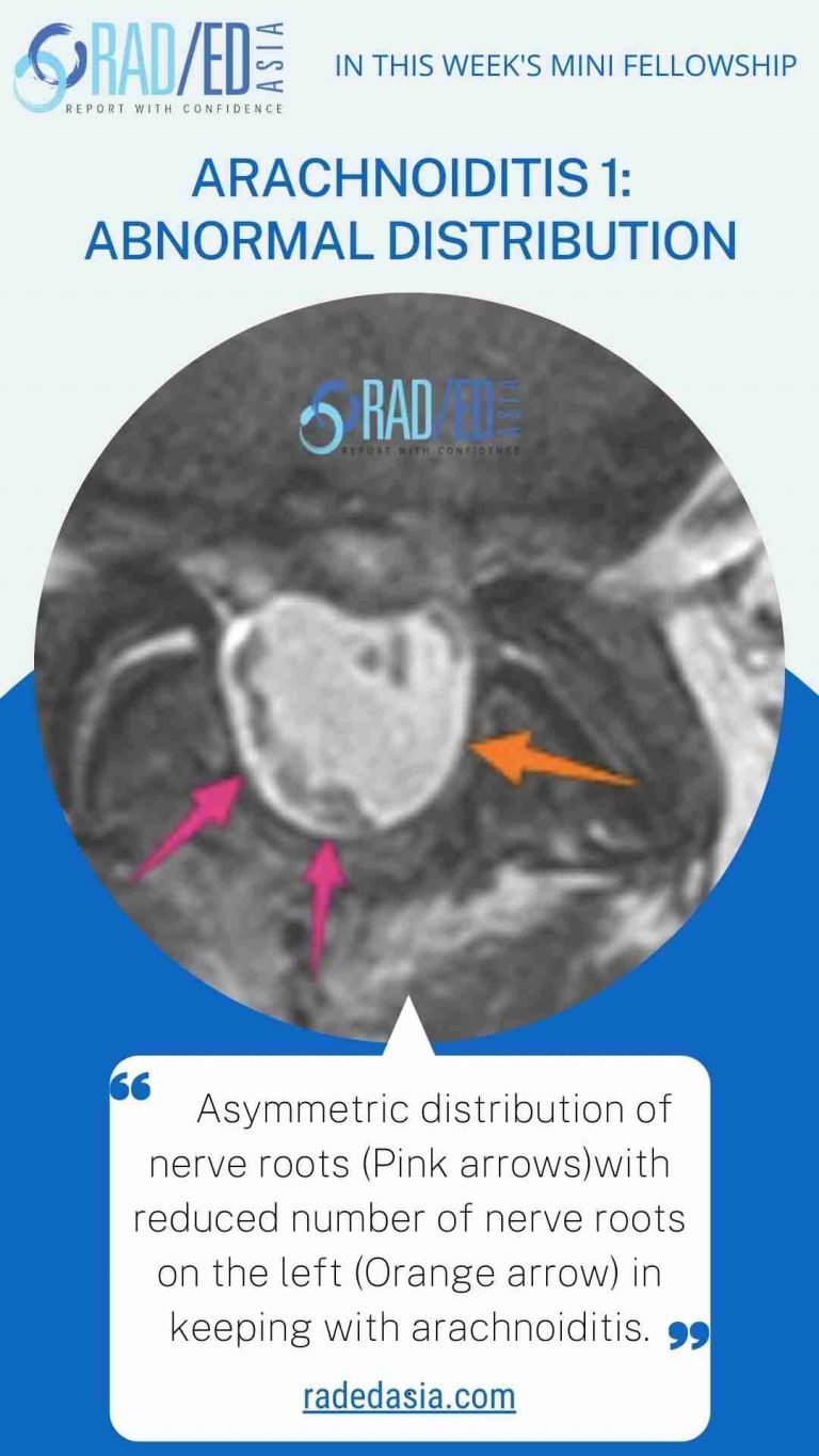 ARACHNOIDITIS MRI SPINE ONLINE RADIOLOGY COURSE - Radedasia