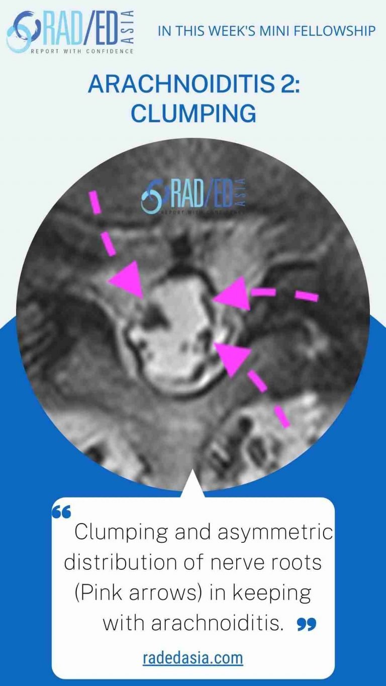 ARACHNOIDITIS MRI SPINE ONLINE RADIOLOGY COURSE - Radedasia