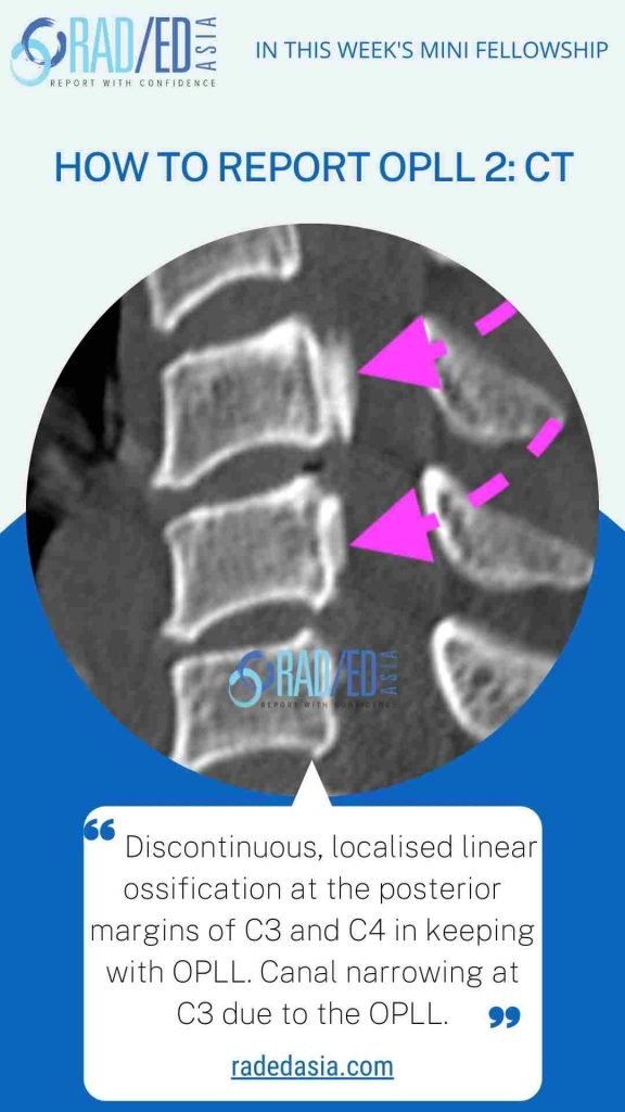 OPLL OSSIFICATION POSTERIOR LONGITUDINAL LIGAMENT: X-RAY, CT, MRI SPINE ...