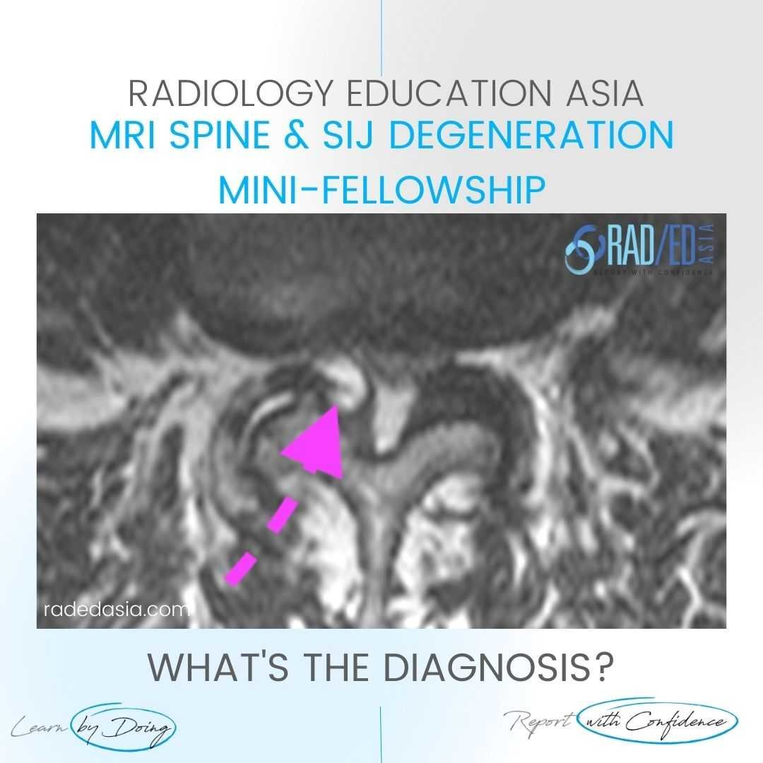 FACET SYNOVIAL CYST RADIOLOGY MRI LUMBAR SPINE Radedasia FACET SYNOVIAL CYST RADIOLOGY MRI LUMBAR SPINE Radedasia