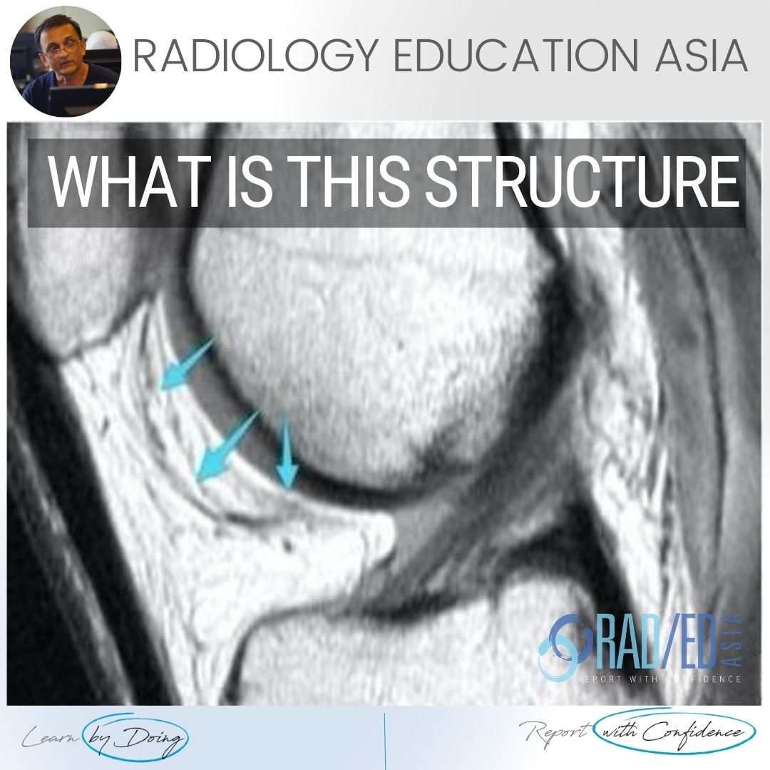 Mri Lower Knee Mri Lower Knee