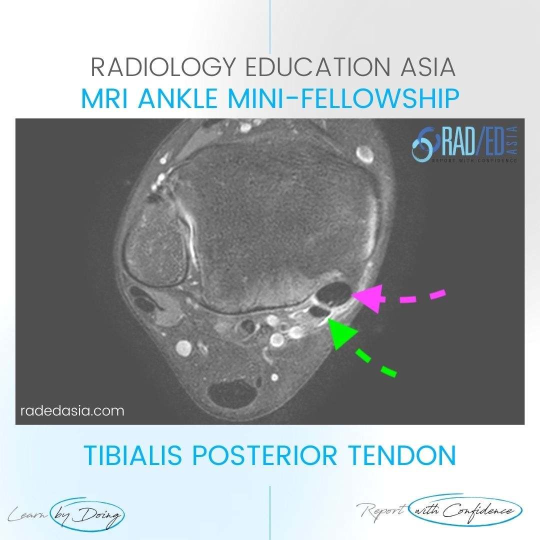 TIBIALIS POSTERIOR TENDINOPATHY MRI RADIOLOGY Radedasia TIBIALIS POSTERIOR TENDINOPATHY MRI RADIOLOGY Radedasia