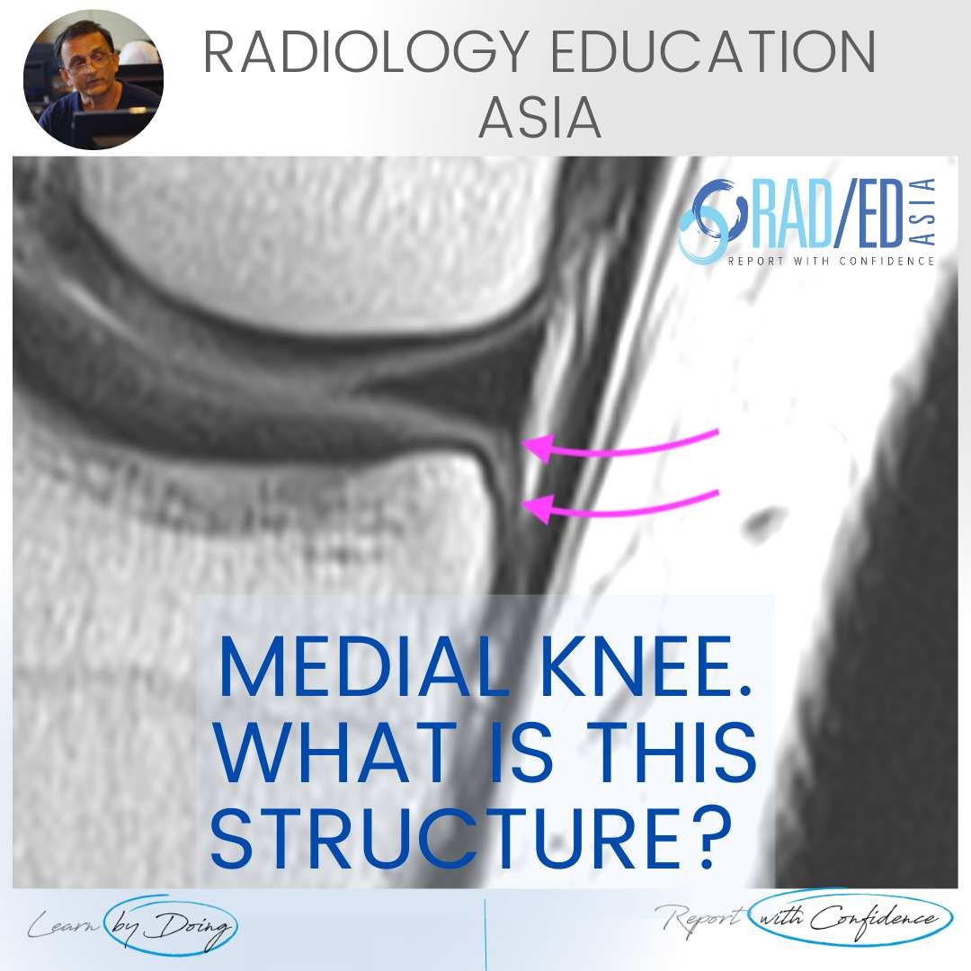 DEEP MCL ANATOMY KNEE MRI RADIOLOGY (VIDEO) - Radiology Education Asia