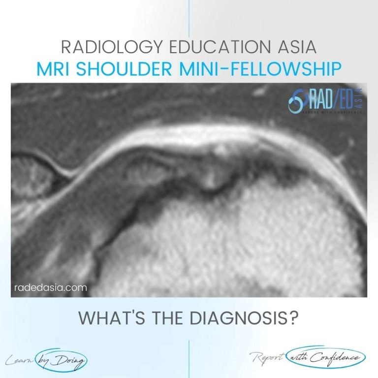 BICEPS DISLOCATION RADIOLOGY MRI SHOULDER - Radiology Education Asia