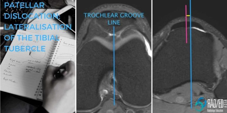 MRI TIBIAL TUBERCLE HOW TO ASSESS LATERALISATION OF THE TIBIAL ...