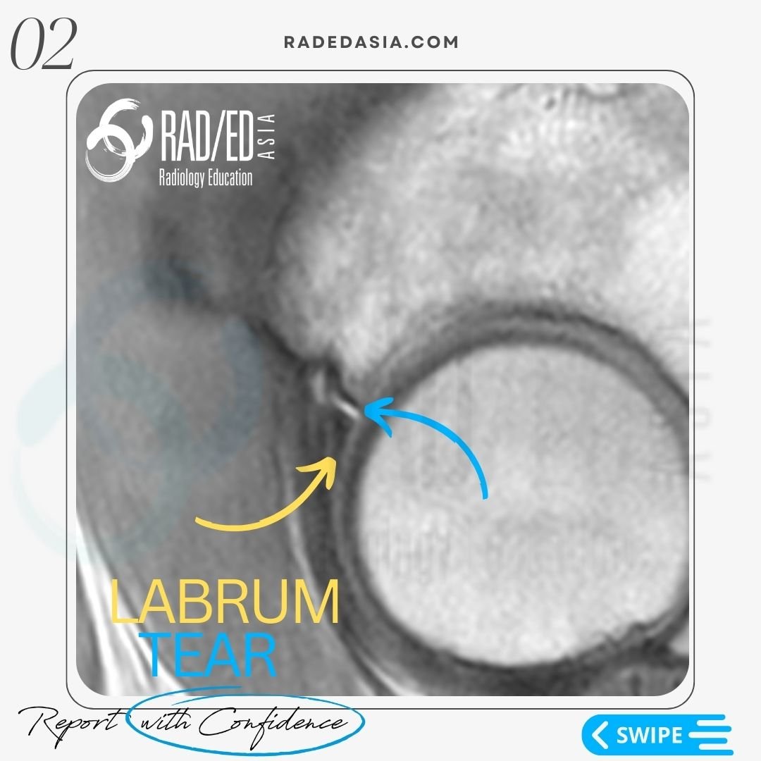 Labral Tear Of Hip Labral Tear Of Hip