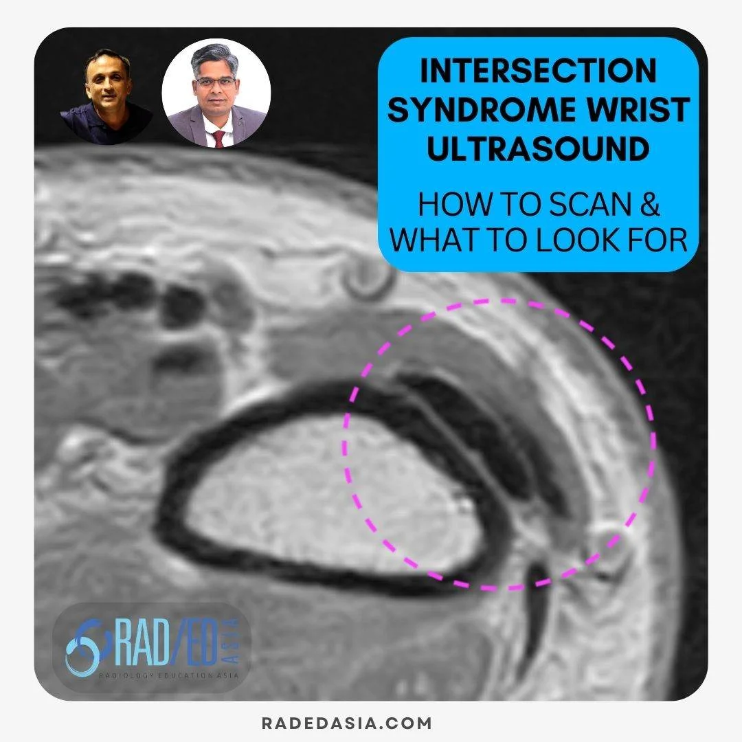 Ultrasound Wrist Intersection Syndrome How To Scan And What To Look For