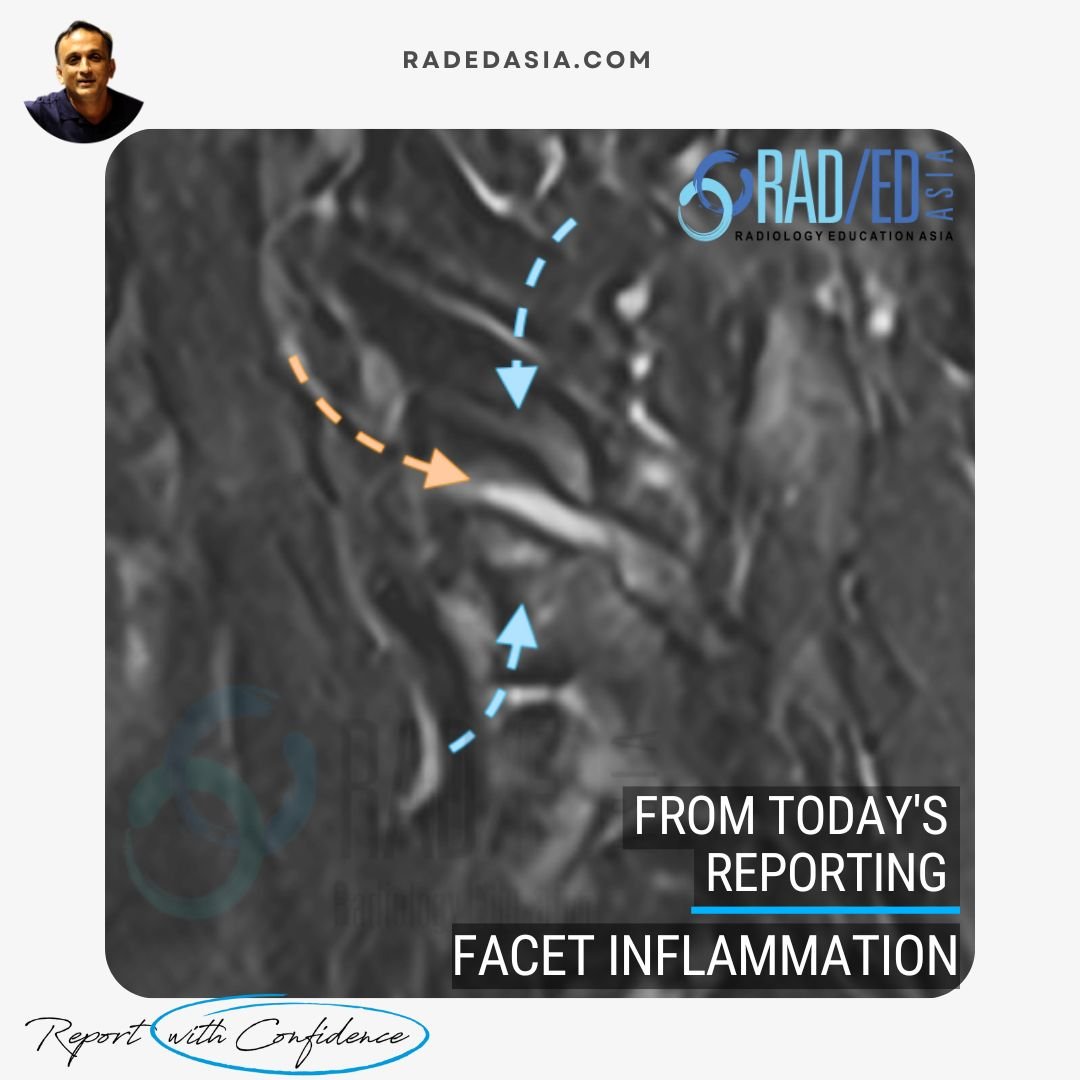 MRI: CERVICAL SPINE FACET JOINT INFLAMMATION - Radiology Education Asia