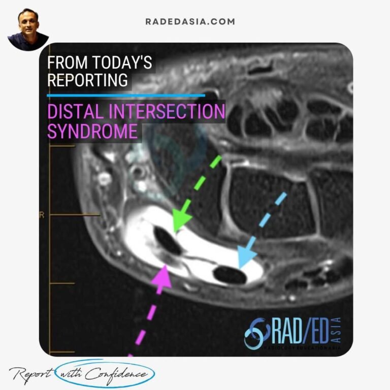 MRI WRIST IMAGING FINDINGS IN DISTAL INTERSECTION SYNDROME - Radiology ...