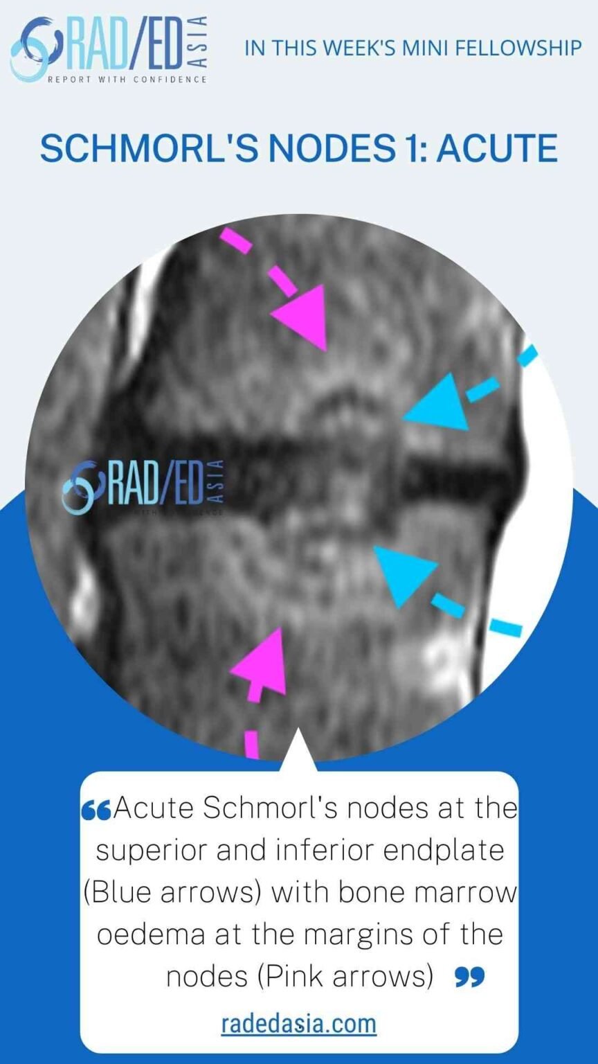 Schmorls Node On Spine Mri Acute And Chronic Schmorls Nodes Mri Radiology Education Asia