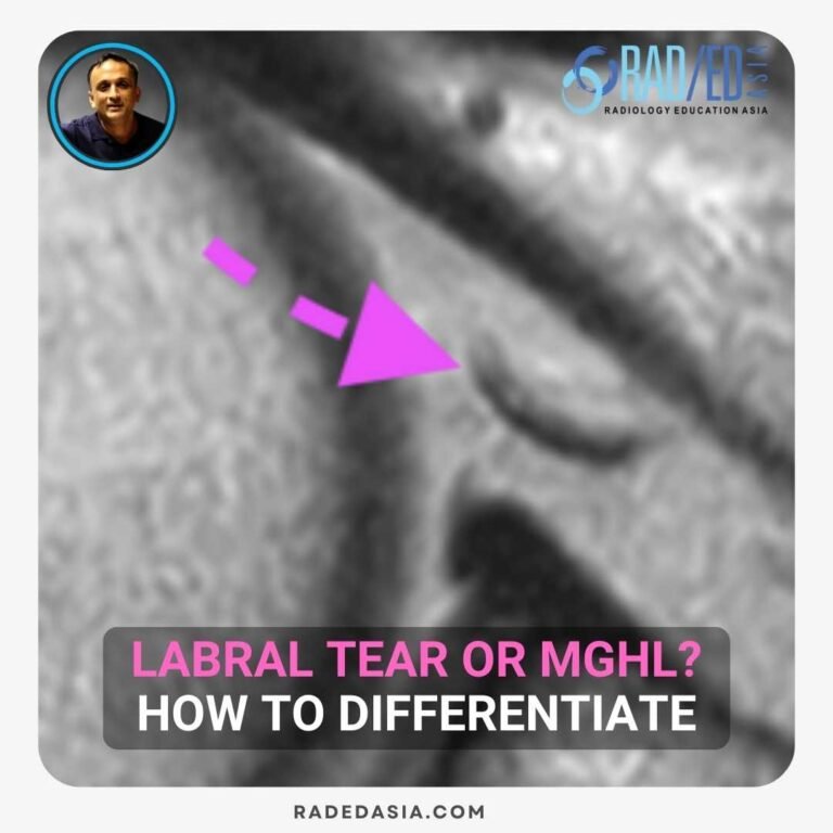 SHOULDER MRI: IDENTIFYING THE MIDDLE GLENOHUMERAL LIGAMENT (MGHL ...