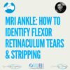 MRI ANKLE: HOW TO IDENTIFY FLEXOR RETINACULUM TEARS AND STRIPPING ...